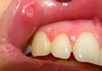 Che cosa sono le afte? | Centro Odontoiatrico Dott. Oreglia